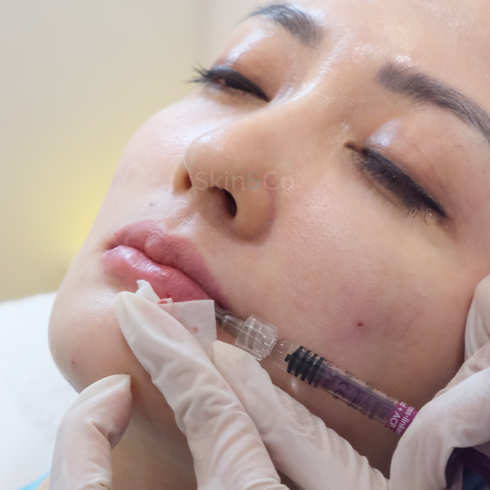 Filler Bibir Transformasi Instan untuk Bibir Lebih Bervolume